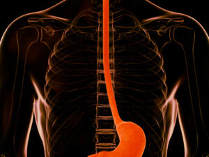 Esofagite é grave? Qual o tratamento indicado? - Gastromed